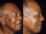 Treating Skin Of Color Minnesota Spokesman Recorder Treating Skin Of Color Minnesota Spokesman Recorder